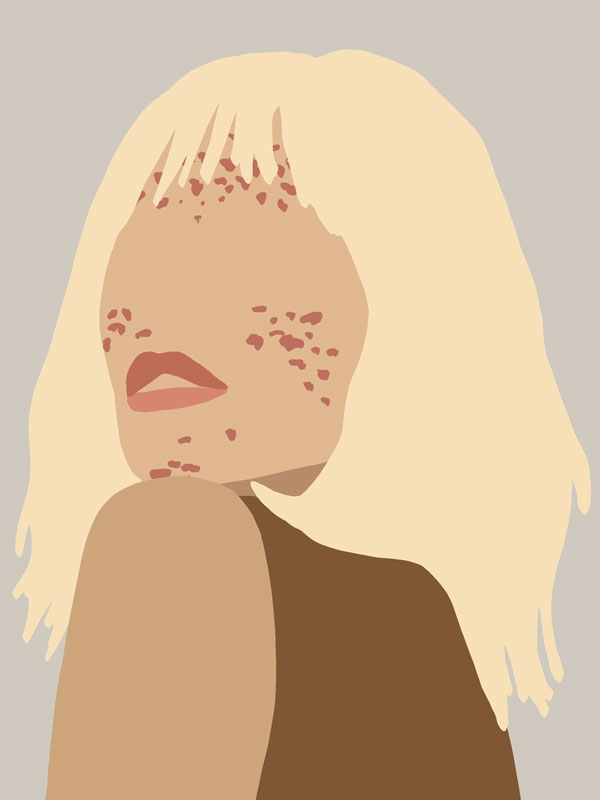 Treatments for Active Acne