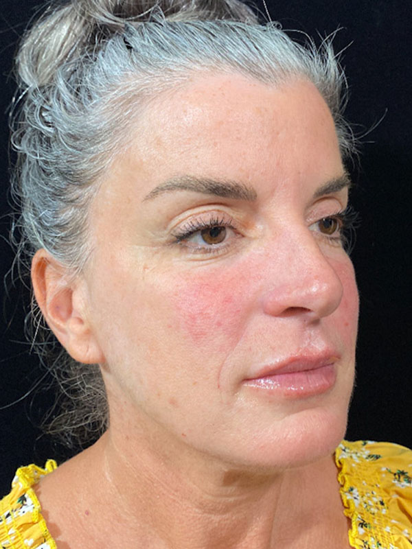 Midface Filler in El Dorado Hills | Esthetics Center