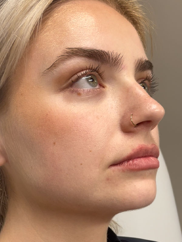 Treatments for Jowls