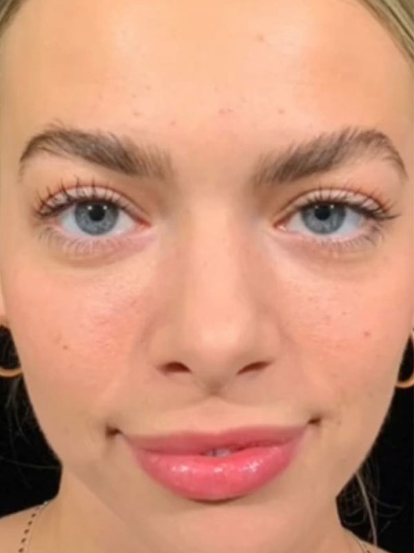 Upperface Filler in El Dorado Hills | Esthetics Center