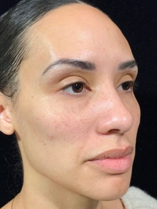 Upperface Filler in El Dorado Hills | Esthetics Center