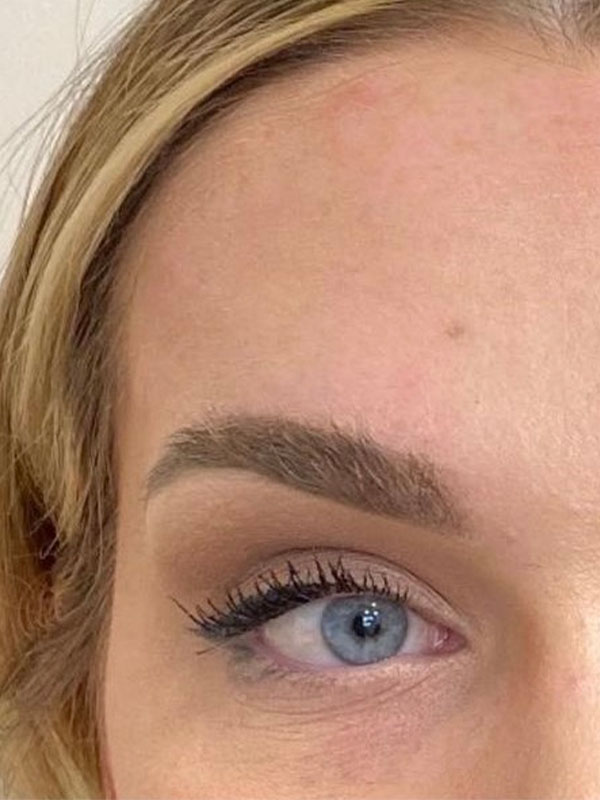 BOTOX in El Dorado Hills | Esthetics Center