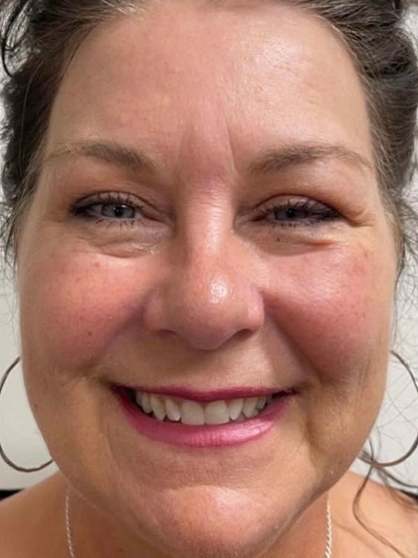 Treatments for Smile Lines