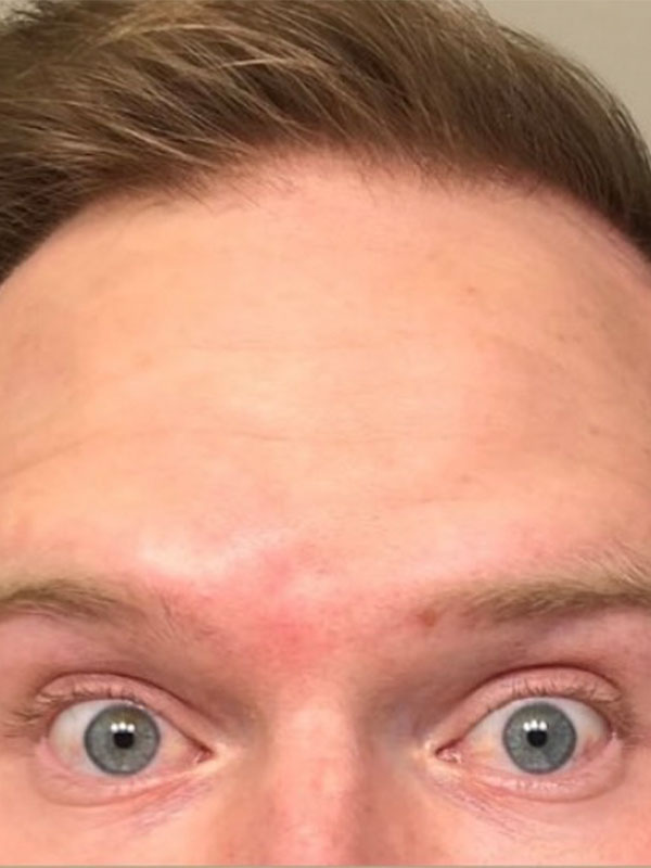 BOTOX in El Dorado Hills | Esthetics Center