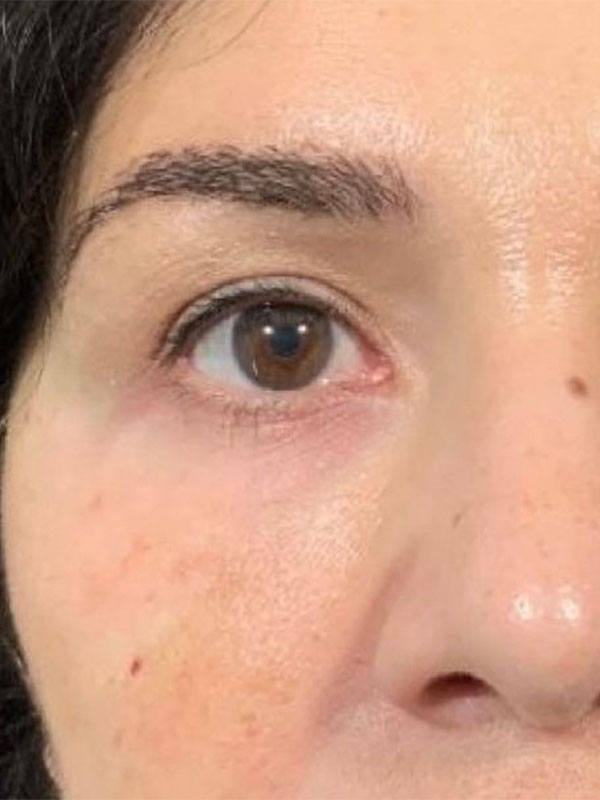 Upperface Filler in El Dorado Hills | Esthetics Center