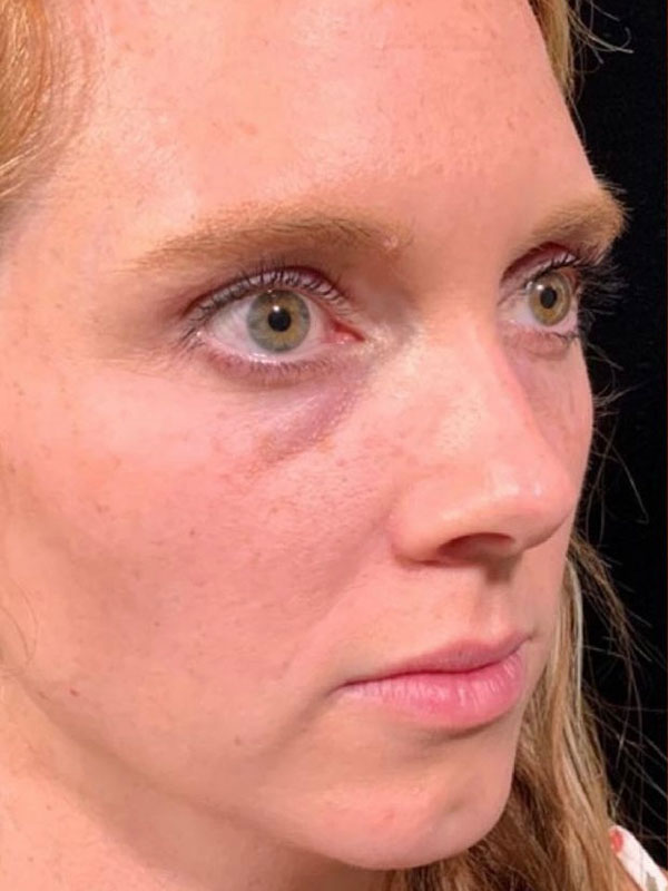 Upperface Filler in El Dorado Hills | Esthetics Center