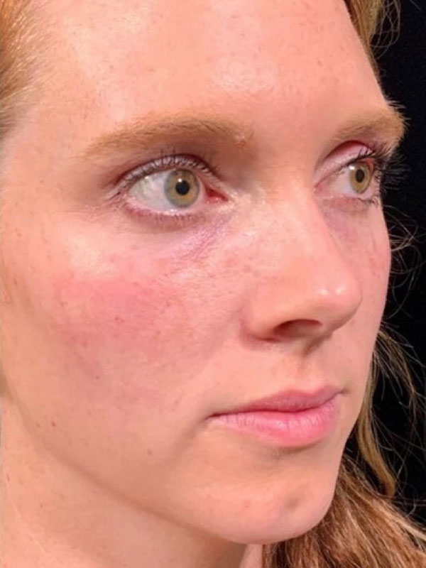 Upperface Filler in El Dorado Hills | Esthetics Center