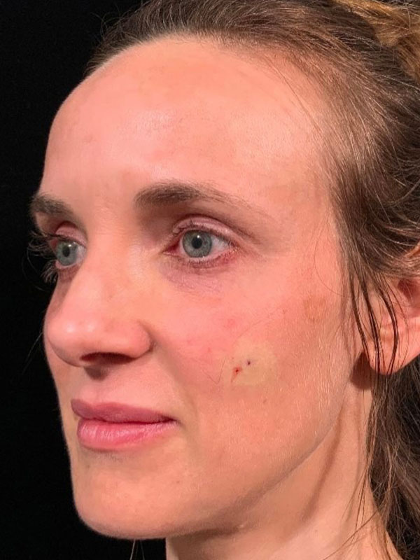 Upperface Filler in El Dorado Hills | Esthetics Center