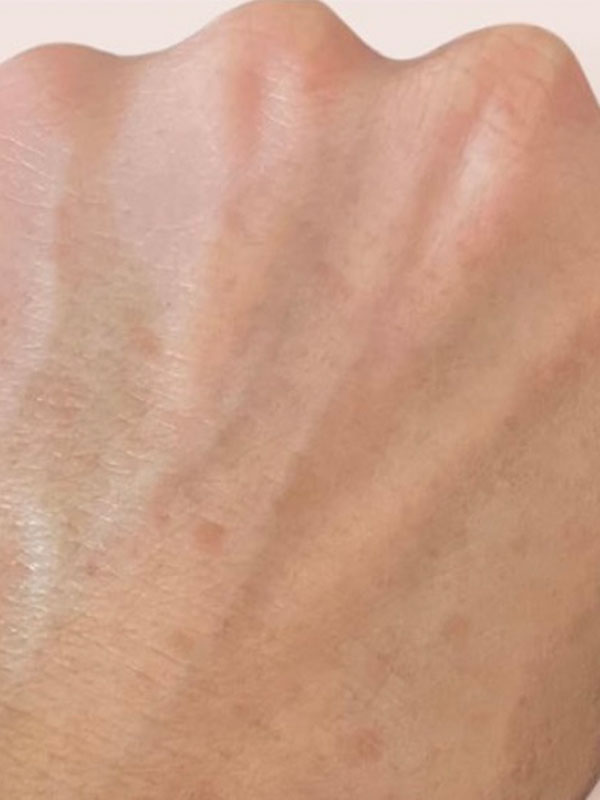 IPL Photofacial in El Dorado Hills | Esthetics Center