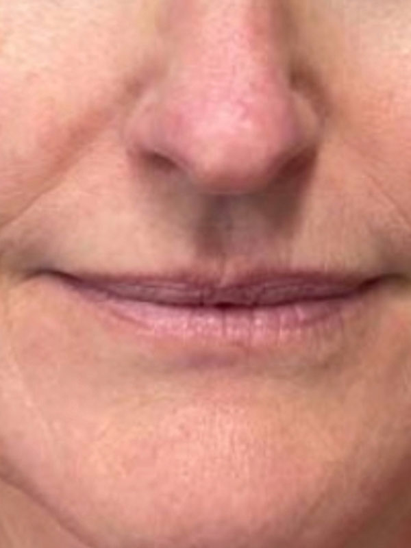 Treatments for Smile Lines