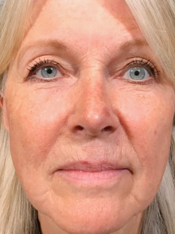 Microcurrent Firming Facial in El Dorado Hills, Sacramento & Rocklin ...