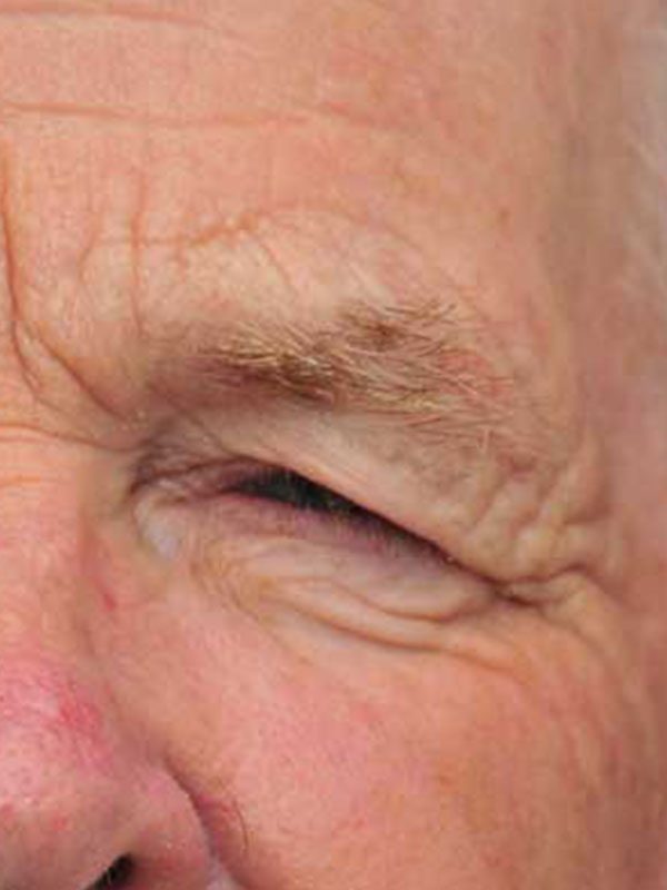 Treatments for Sagging Brow