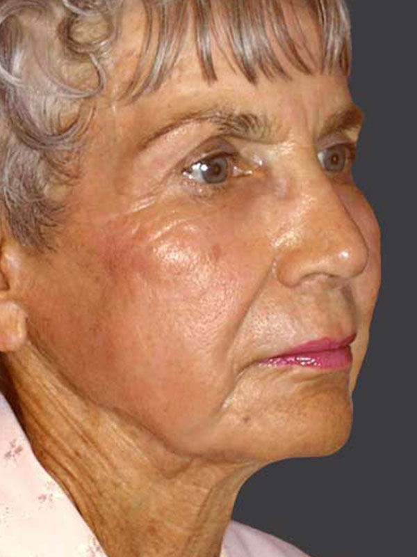 C02 Laser Resurfacing in El Dorado Hills, Sacramento & Rocklin ...