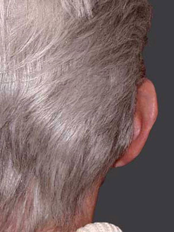 Ear Pinning in El Dorado Hills, Sacramento & Rocklin - Esthetics Center