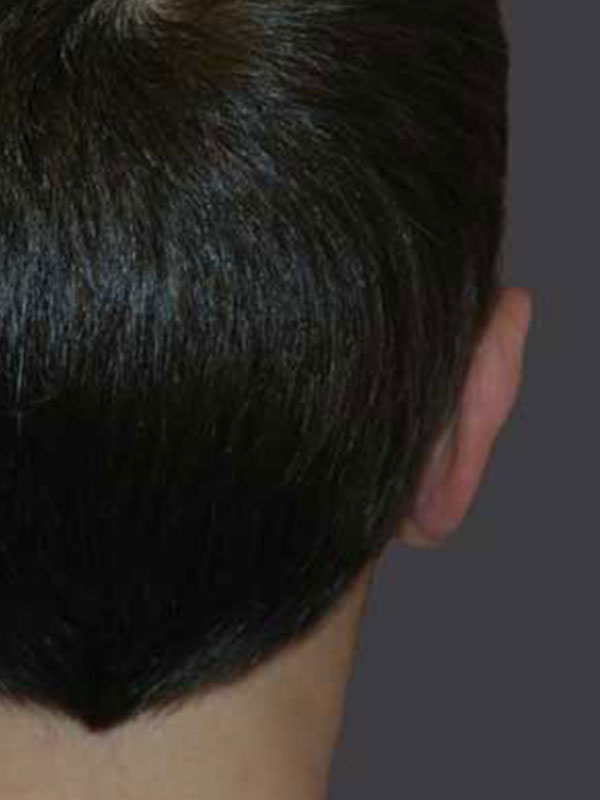 Ear Pinning in El Dorado Hills, Sacramento & Rocklin - Esthetics Center