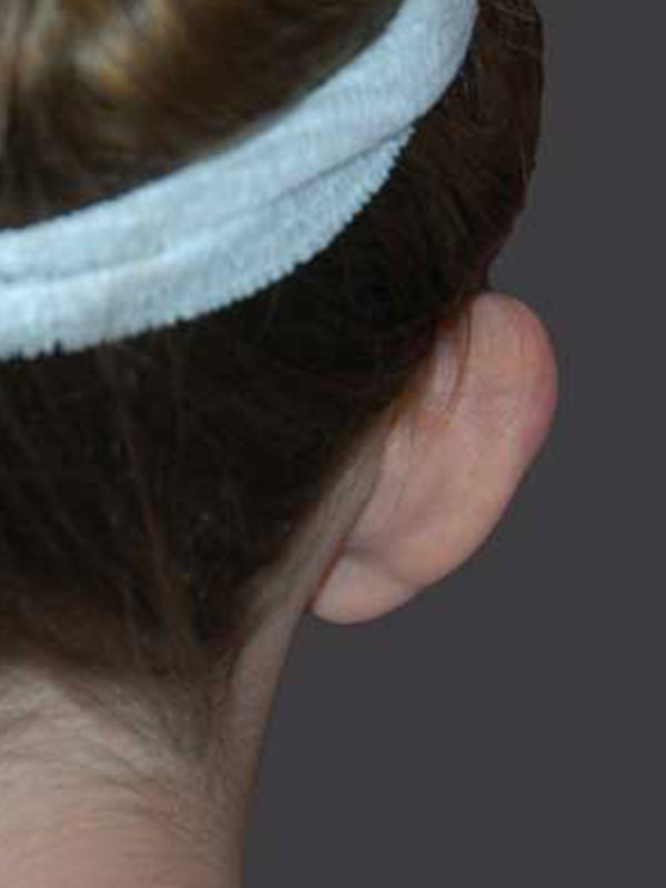 Ear Pinning in El Dorado Hills, Sacramento & Rocklin - Esthetics Center