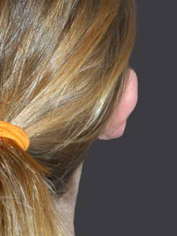 Ear Pinning in El Dorado Hills, Sacramento & Rocklin - Esthetics Center