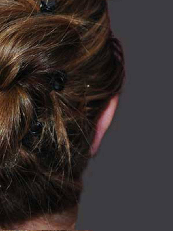 Ear Pinning in El Dorado Hills, Sacramento & Rocklin - Esthetics Center