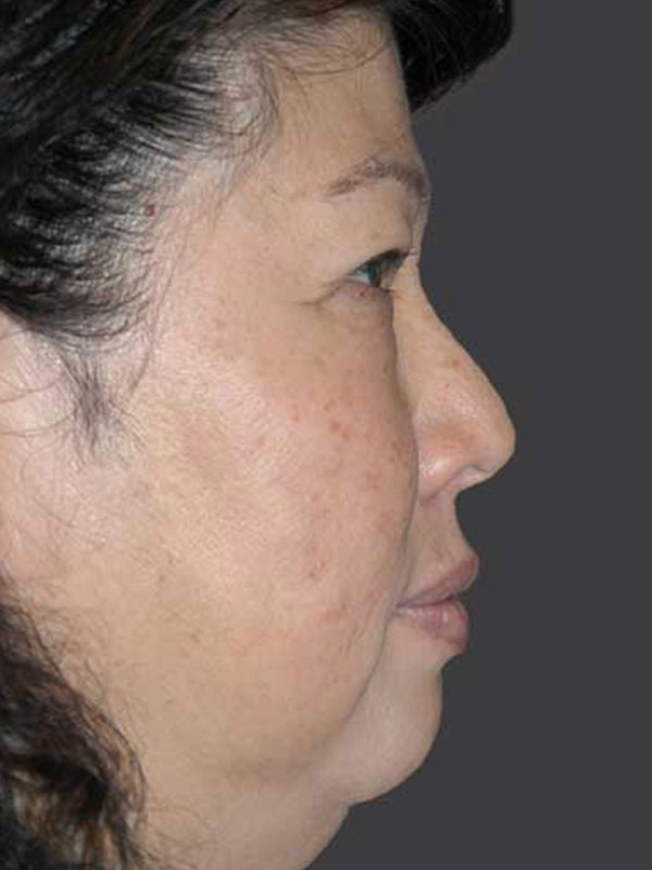 Chin Implant in El Dorado Hills | Esthetics Center