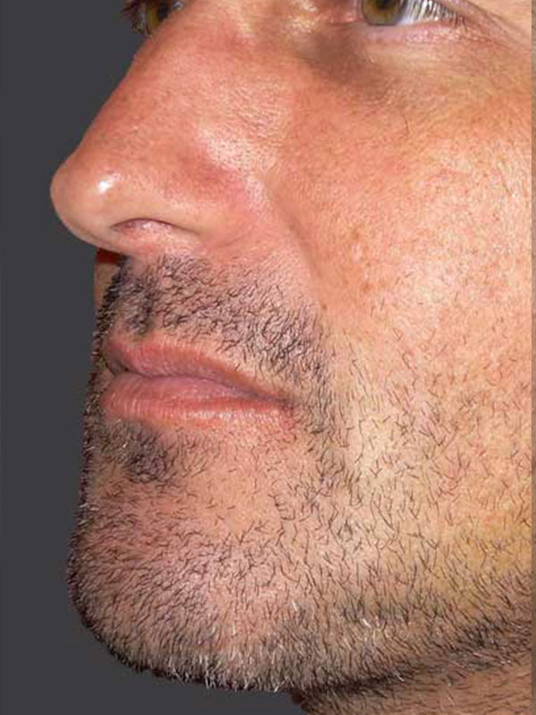 Chin Implant in El Dorado Hills | Esthetics Center