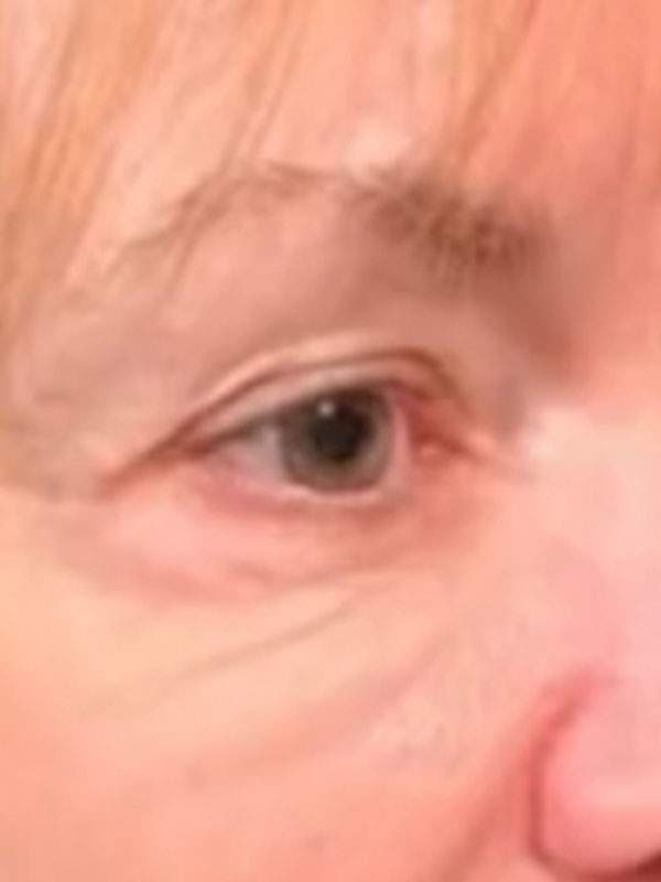 Treatments for Heavy Eyelids