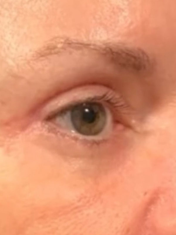 Treatments for Heavy Eyelids