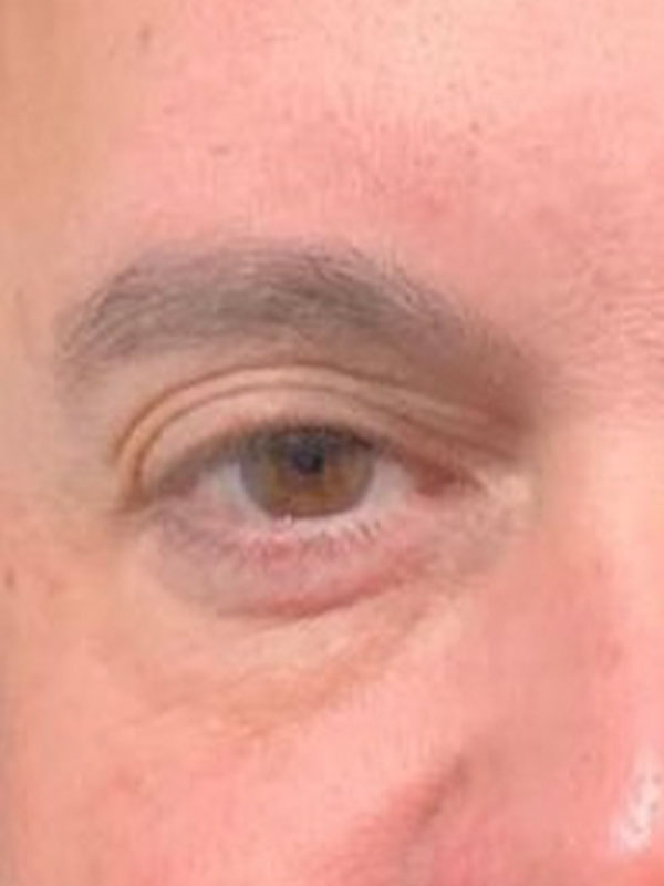 Treatments for Heavy Eyelids