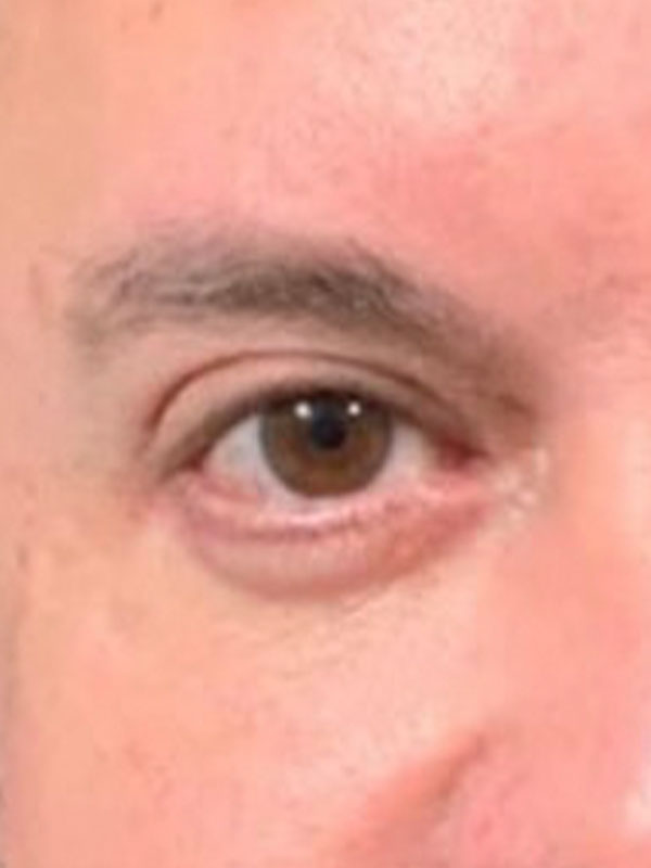 Treatments for Heavy Eyelids
