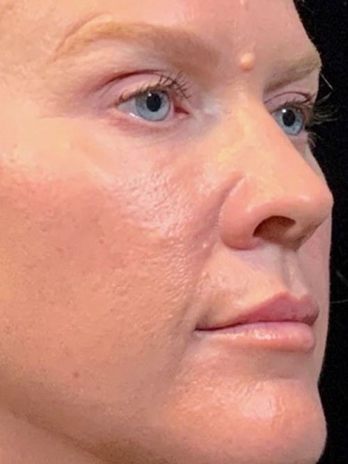 Profound RF Microneedling in El Dorado Hills | Sacramento & Rocklin ...