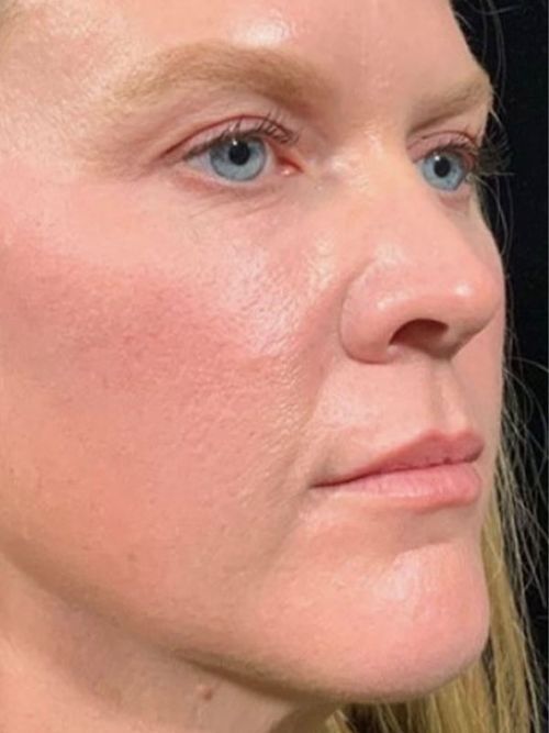 Profound RF Microneedling in El Dorado Hills | Sacramento & Rocklin ...