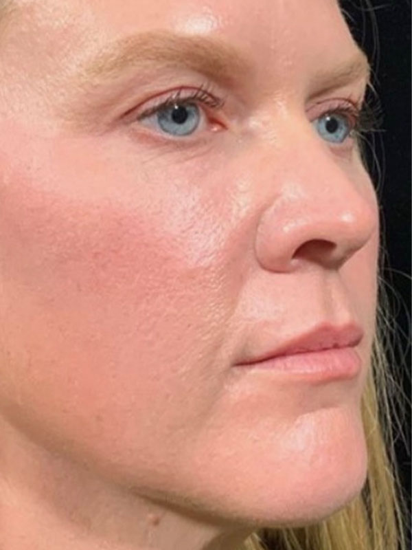 Profound RF Microneedling in El Dorado Hills | Sacramento & Rocklin ...