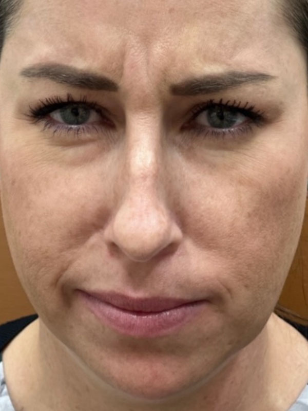 BOTOX in El Dorado Hills | Esthetics Center