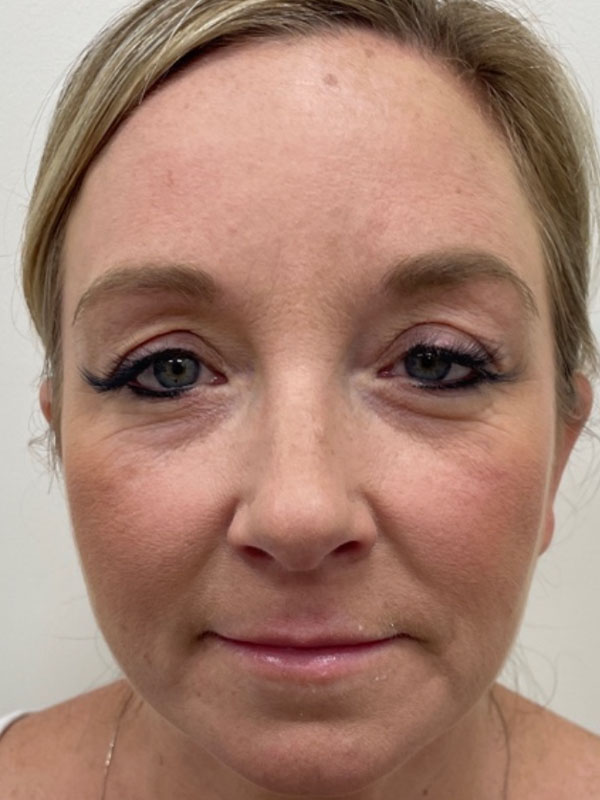 Midface Filler in El Dorado Hills | Esthetics Center