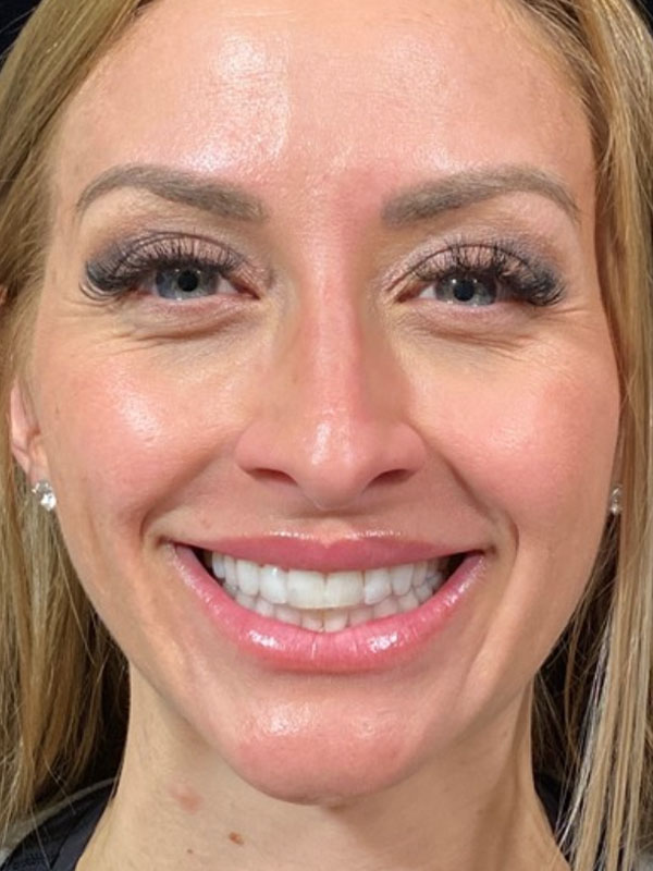 Midface Filler in El Dorado Hills | Esthetics Center