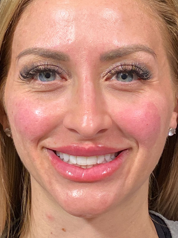 Midface Filler in El Dorado Hills | Esthetics Center