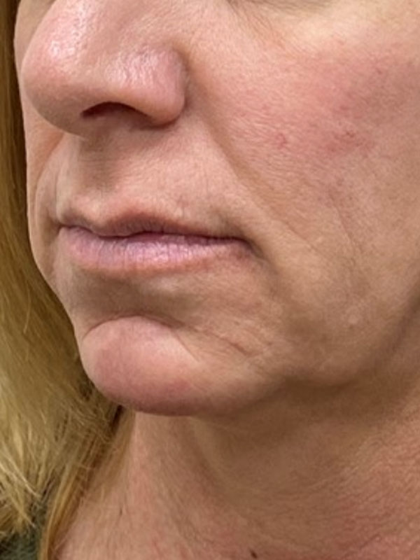 Midface Filler in El Dorado Hills | Esthetics Center