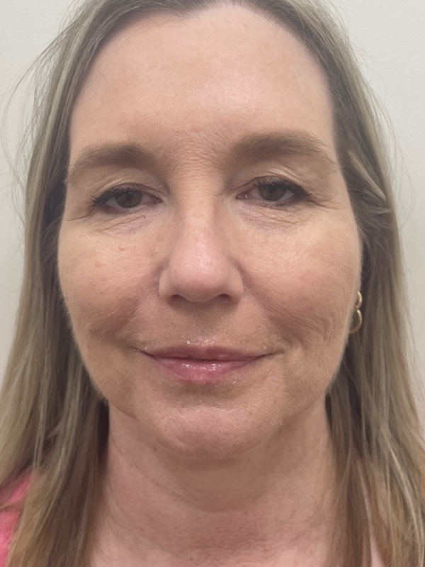 Midface Filler in El Dorado Hills | Esthetics Center