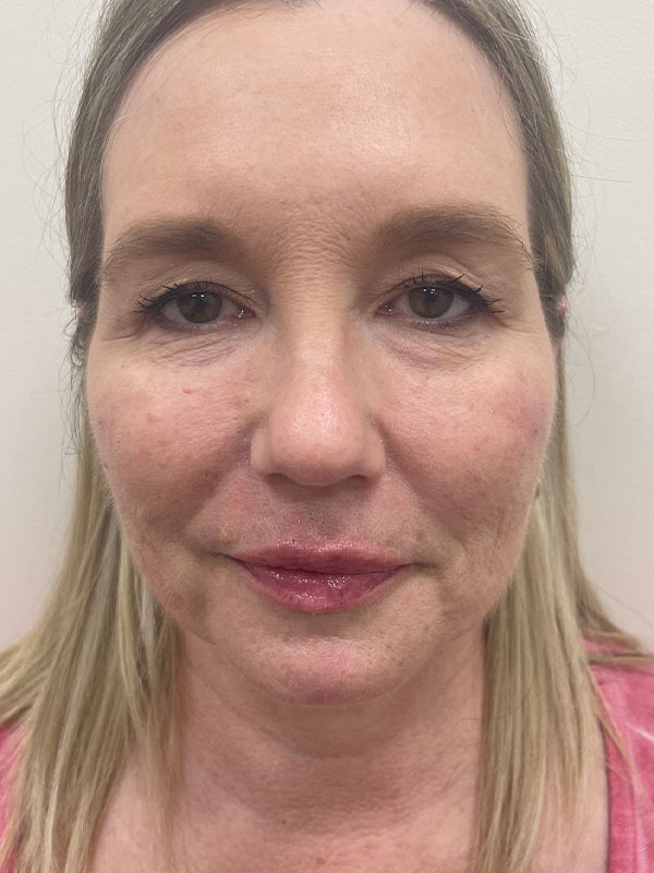 Midface Filler in El Dorado Hills | Esthetics Center