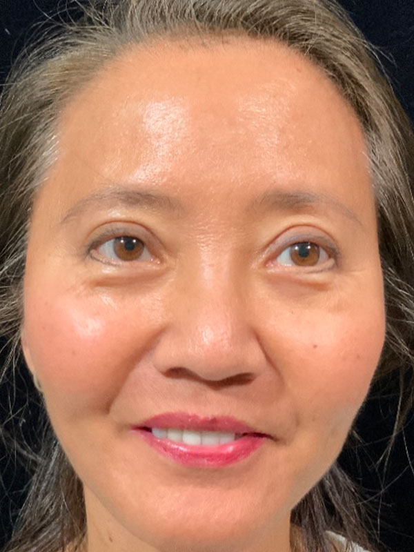 Treatments for Skin Laxity