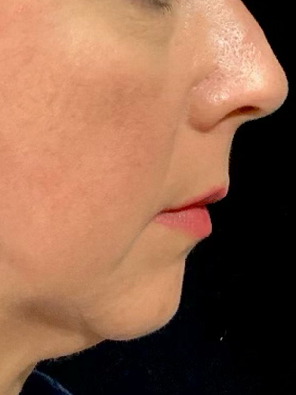 Midface Filler in El Dorado Hills | Esthetics Center