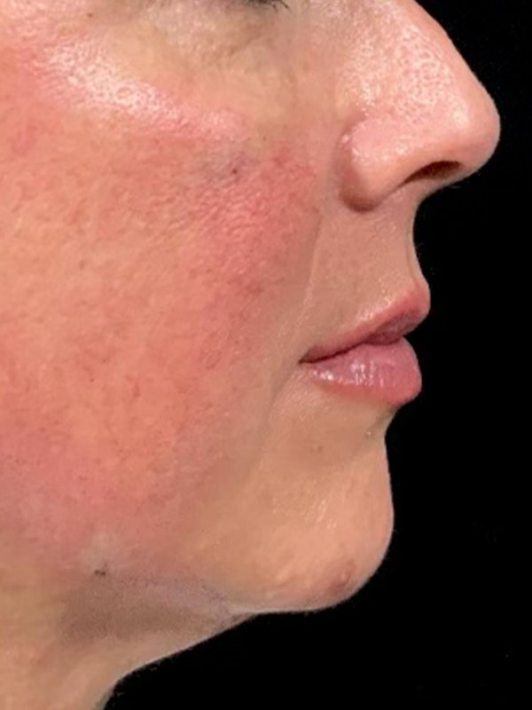 Midface Filler in El Dorado Hills | Esthetics Center