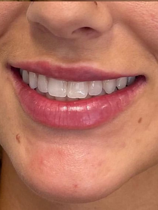 Lip Flip in El Dorado Hills | Esthetics Center