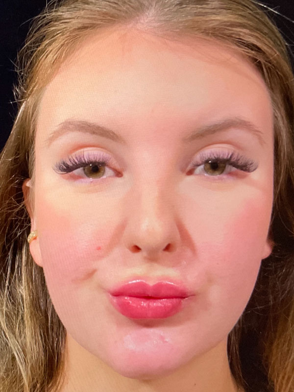 Lip Filler in El Dorado Hills | Esthetics Center