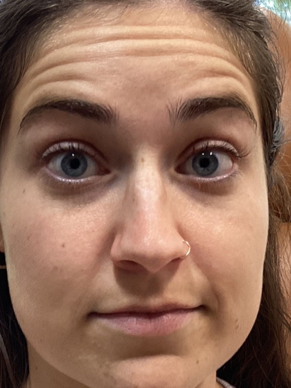 BOTOX in El Dorado Hills | Esthetics Center