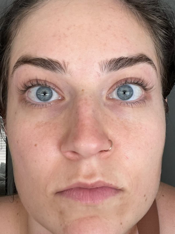 BOTOX in El Dorado Hills | Esthetics Center