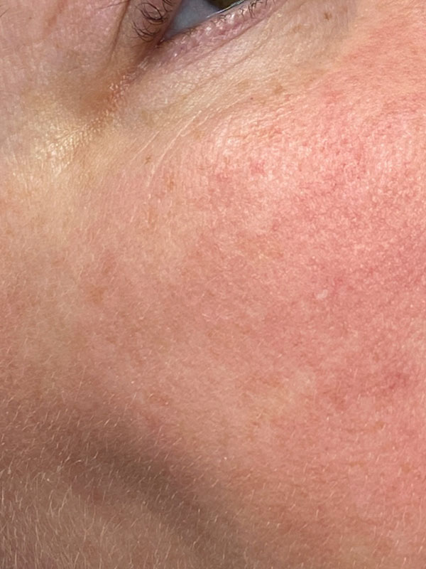 IPL Photofacial in El Dorado Hills | Esthetics Center