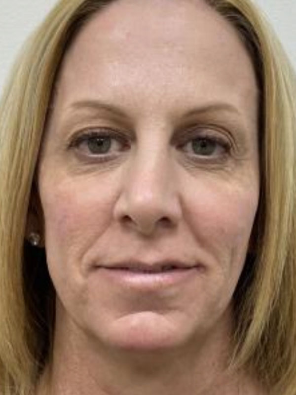 Midface Filler in El Dorado Hills | Esthetics Center