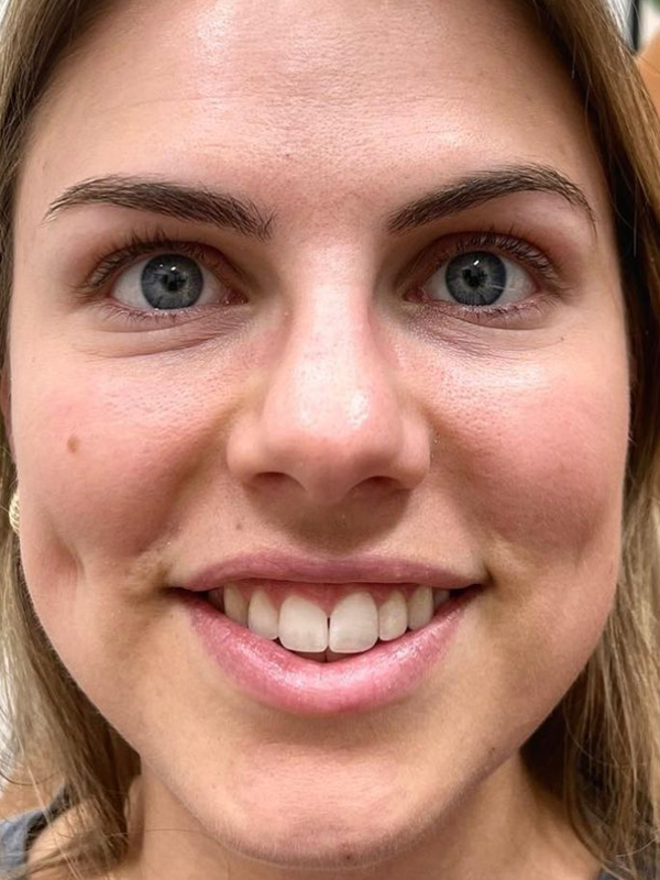 Treatments for Sagging Brow