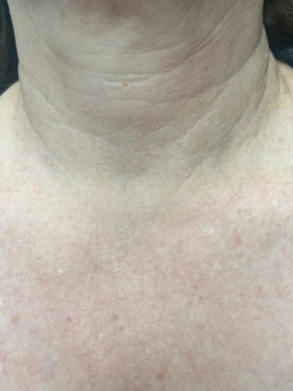 FRAX Laser Resurfacing in El Dorado Hills, Sacramento & Rocklin ...