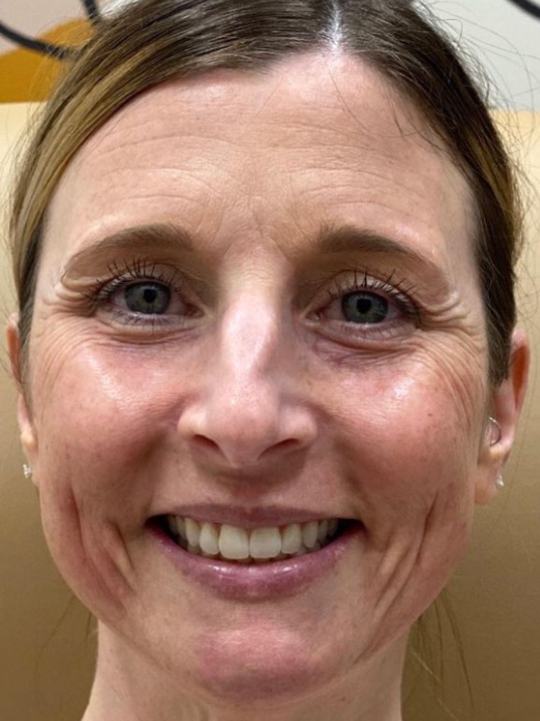 Treatments for Marionette Lines